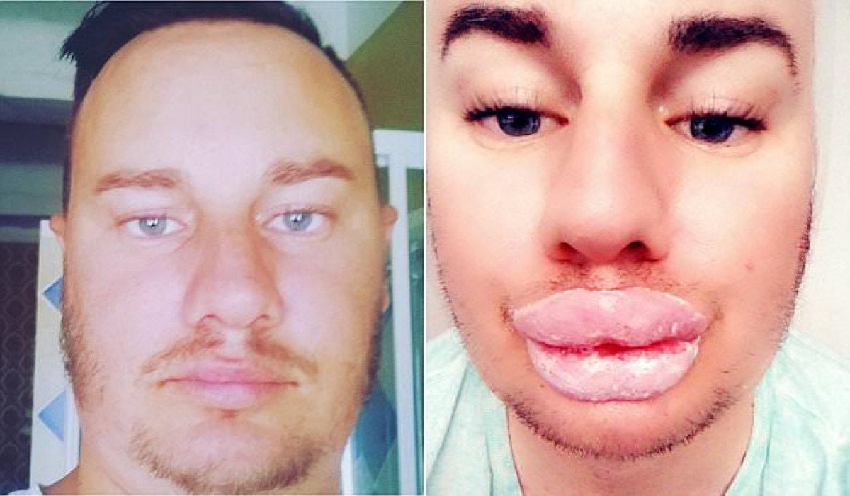 Gastó 10 mil dólares en relleno para labios y botox. Ahora prepara ...